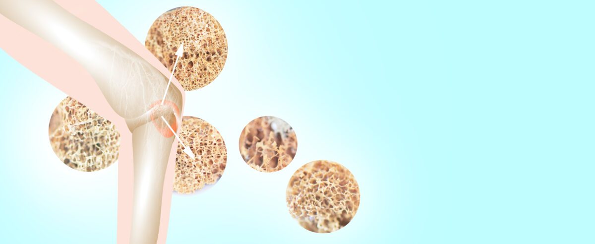 Osteopenia Vs. Osteoporosis – Distinct Differences That Will Actually ...