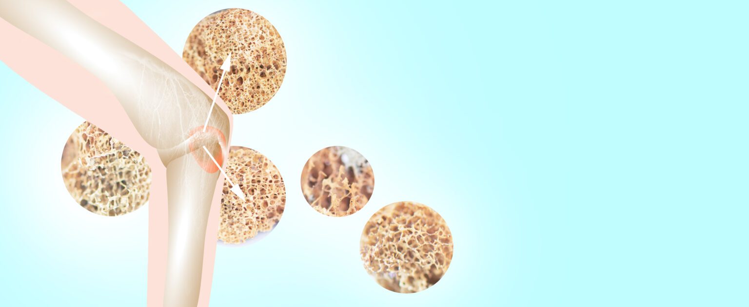 Osteopenia Vs. Osteoporosis – Distinct Differences That Will Actually ...